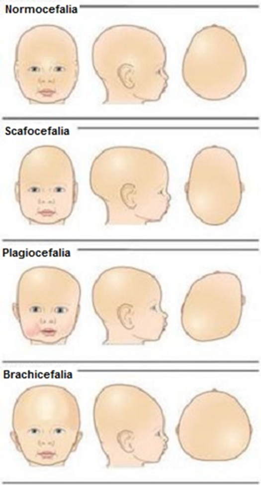 BLOG Pediatra: La “testa piatta” del bebè: quando diventa un problema ...